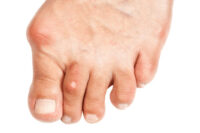 Ainevahetuslik polü artriit, podagra - Loodus BioSpa